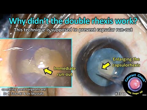 CataractCoachâ„¢ 2348: Why didn't the double rhexis work?