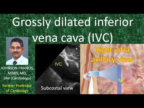 Grossly dilated inferior vena cava and right infra axillary view for IVC