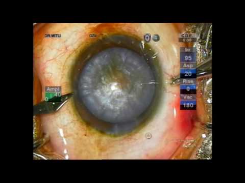 White intumsecent hard cataract with double rhexis