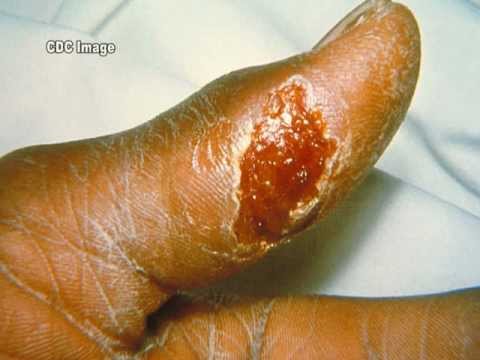 Tularemia and Francisella tularensis