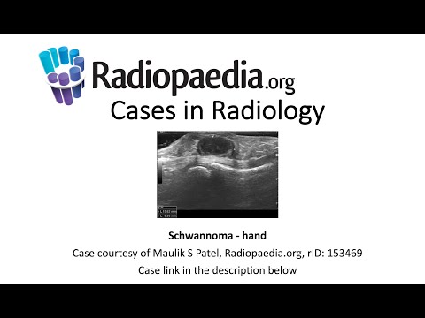 Hand Schwannoma (Radiopaedia.org) Cases in Radiology