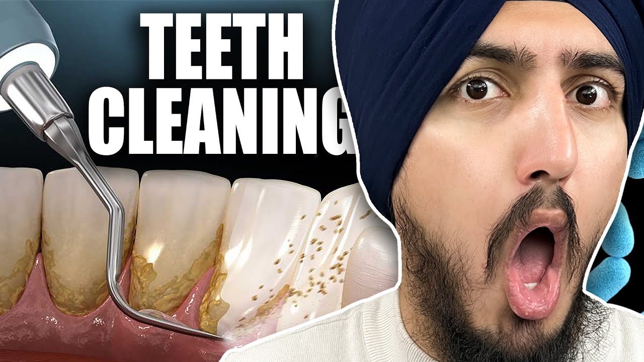 When Do You REALLY Need A TEETH CLEANING?