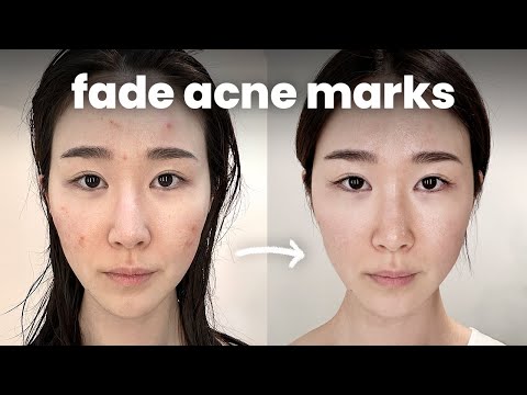 How I Fade Acne Marks Fast (Acne Scars & Hyperpigmentation)