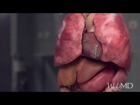 Where Advanced Colon Cancer Spreads | WebMD