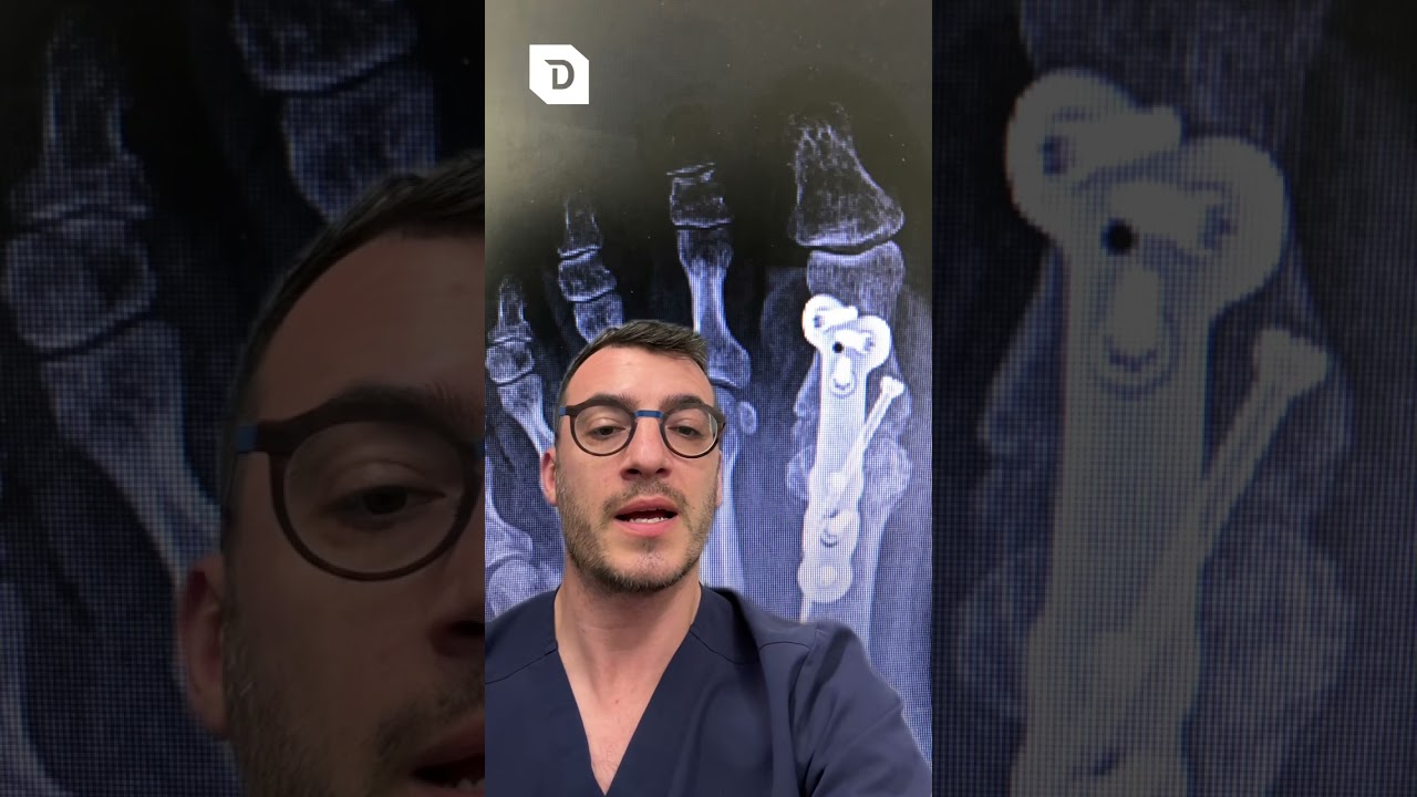 Fusion of the big toe joint