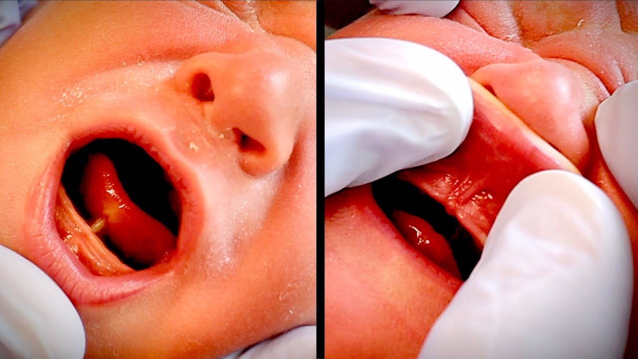 NEWBORN WITH DOUBLE TONGUE TIE | Dr. Paul