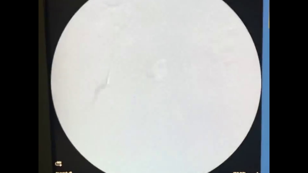 Uterine Fibroid Embolization at Work