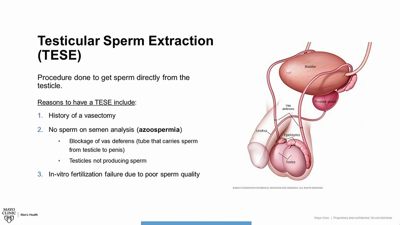 Testicular Sperm Extraction (TESE) Procedure- Overview