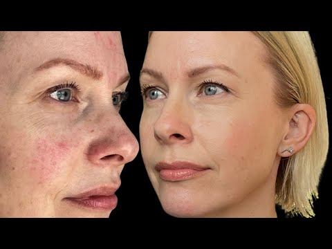 HOW I FIXED my rosacea ‼