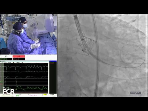 Challenges and solutions in an expanding TAVI world - EuroPCR 2025