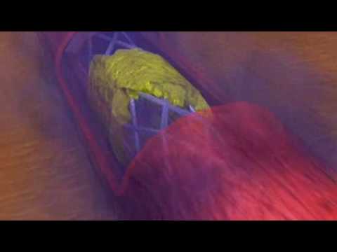Drug Eluting Stent