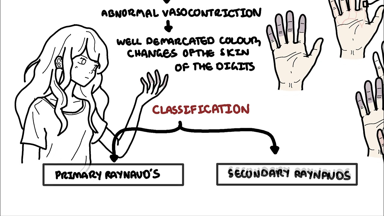 Raynaud's Phenomenon - mechanism