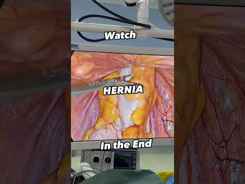 Watch HERNIA in the End I Hernia Meaning I Hernia Treatment I Abdominal Hernia