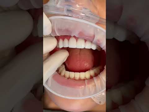 Porcelain Veneers By Dr. Tejas Patel #cosmeticdentist #veneers #bestcosmeticdentist