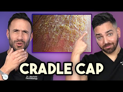 How to Treat Cradle Cap like a Dermatologist | Doctorly Dads
