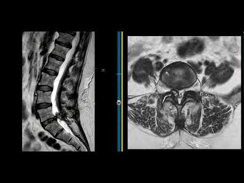 Synovial cyst facet joint