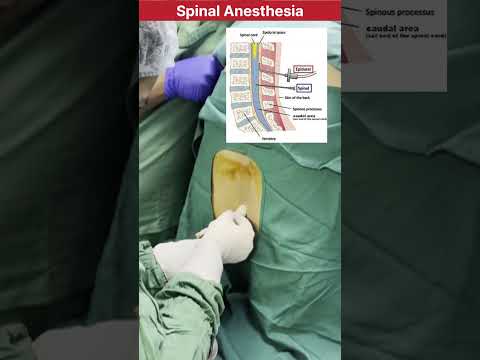 How spinal Anesthesia procedure is performed in Surgery #doctor #mbbs #neet #medical #anesthesia