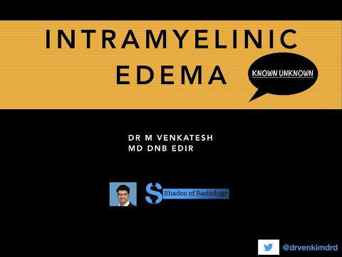 Intramyelinic edema – Known Unknown – Radnucleus