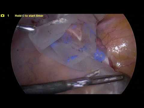 Lap ovarian dermoid excision POD extraction