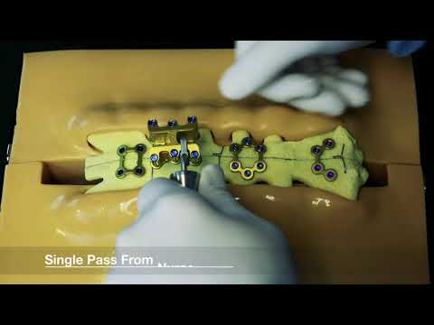 JACE Medical- Low Profile Anatomic Plates