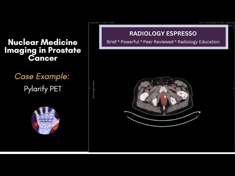 NUCLEAR MEDICINE IMAGING IN PROSTATE CANCER: Case Example – Pylarify PET Scan (5560)