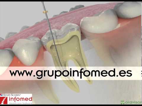 Oravisor Dental Software: Manual endodontics and placing crown