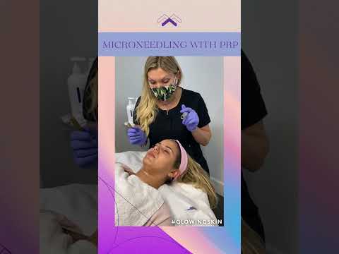 Micro-Needling with PRP!