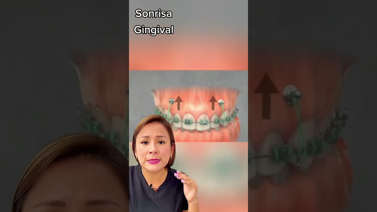 ¿Sonrisa gingival?👀