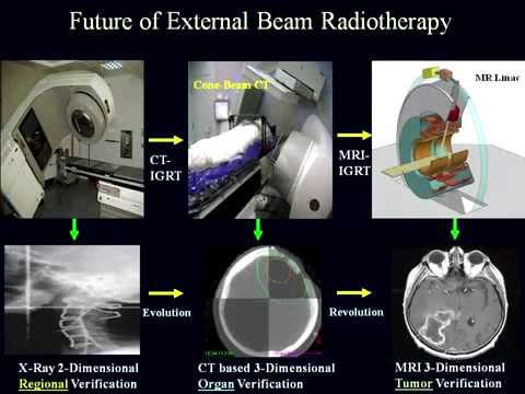 New Developments in Radiation for Brain Tumours: Arjun Sahgal