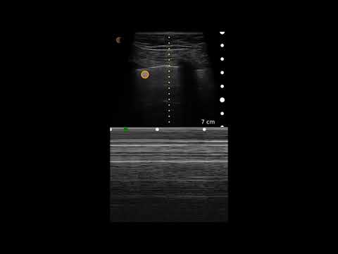 Pneumothorax: Ultrasound Image Interpretation