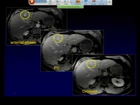 Liver Disease MRI 1