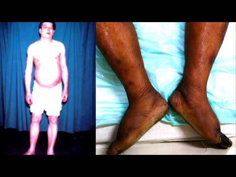 Myxedema Coma in 3 minutes, Symptoms, Causes, Signs