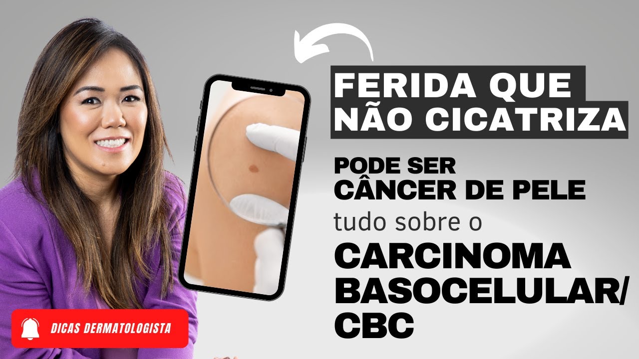 CANCER DE PELE MAIS COMUM - CBC | DERMATOLOGISTA / DRA. JULIANA TOMA