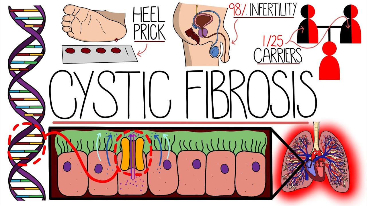 Understanding Cystic Fibrosis: Pathophysiology and Diagnosis | Galaxy.ai