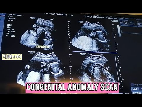 CONGENITAL ANOMALY SCAN || 22 WEEKS || ULTRASOUND