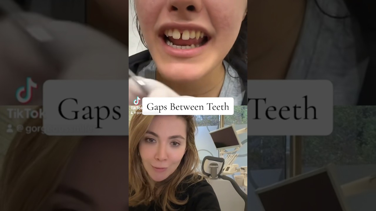 2 Ways To Close Front Teeth Gaps!