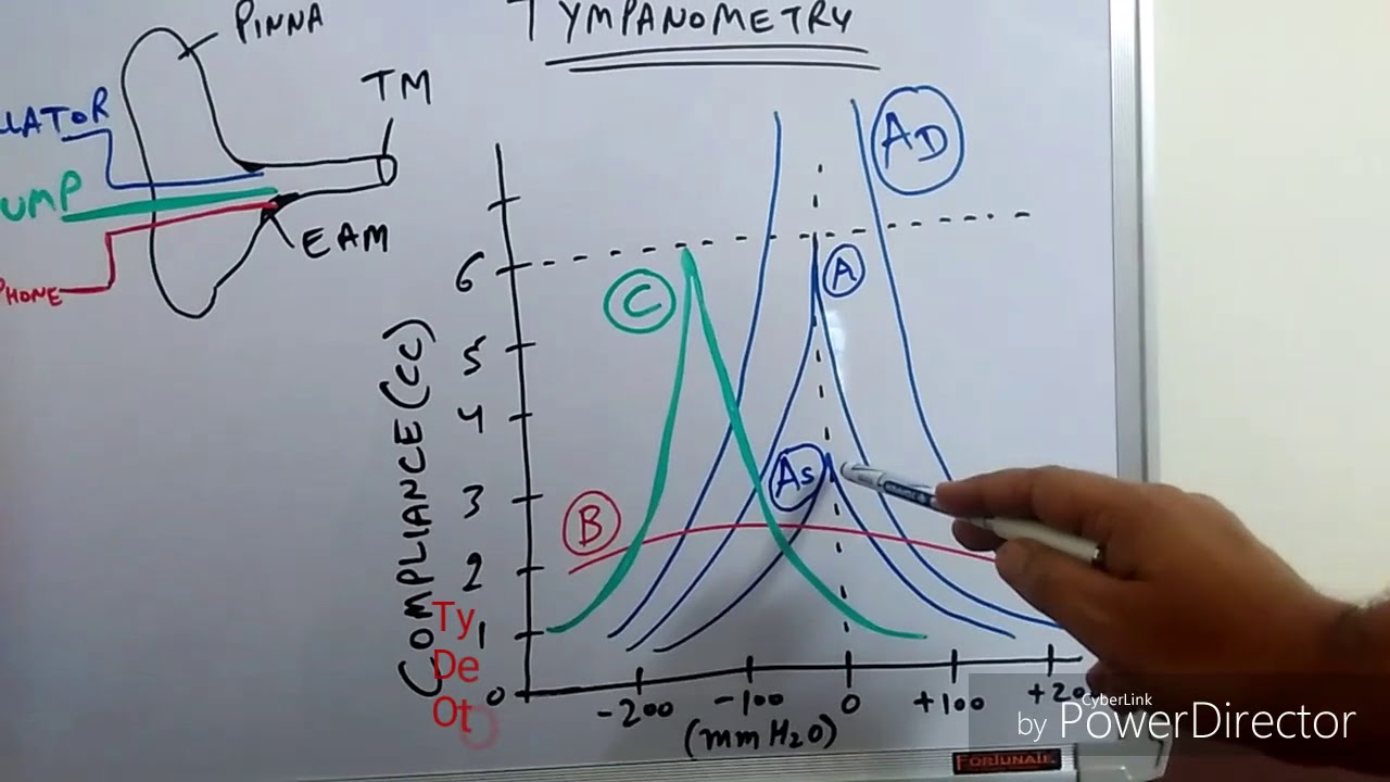 Tympanometry (Impedance Audiometry)