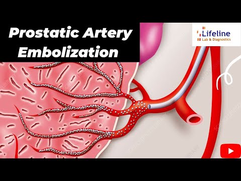 prostatic artery embolization treatment of minimally invasive treatment for enlarged prostate.
