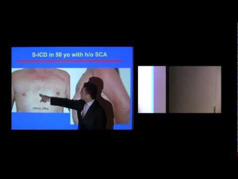 The Subcutaneous only ICD