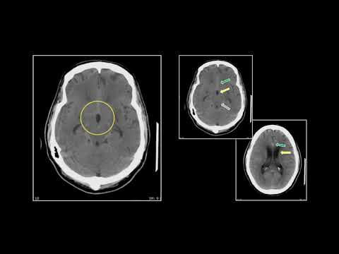 Neuroradiology Infections | Interesting Radiology Cases