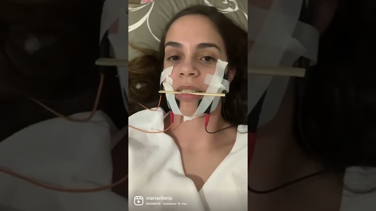 Um pouco da minha cirurgia ortognática