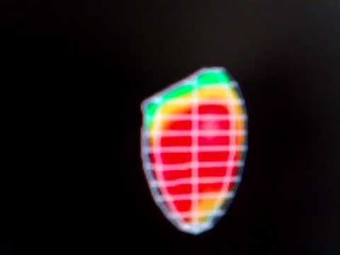 scintigraphie myocardique
