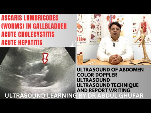 Cholecystitis ultrasound | Worm in gallbladder | gallbladder ultrasound | abdominal ultrasound | usg