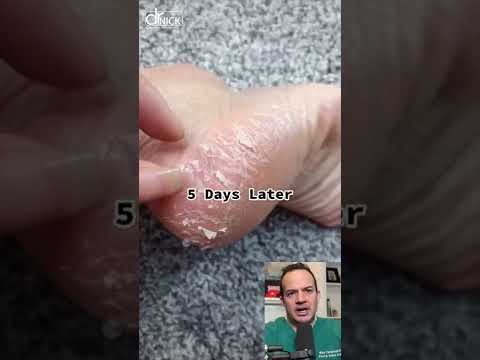 DOCTOR REACTS TO CHEMICAL FOOT PEEL!😱😫 #shorts #reaction