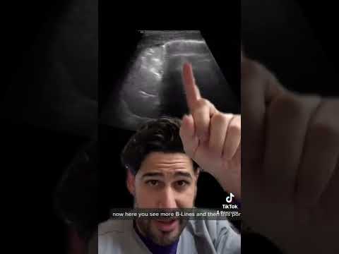 Lung 🫁 POCUS