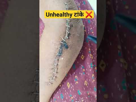 Healthy Vs Unhealthy Stitches टांके 🪡🔥🔥#stitches #postsurgery #woundhealing #wound #fracturerecovery
