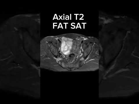 Sacroilitis mri radiopaedia #youtubeshorts #shortvideo #shorts