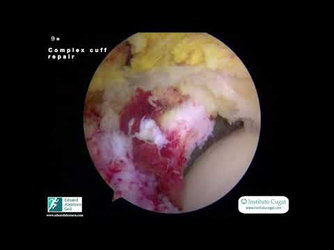 Complex rotator cuff repair - footprint medialización and interval slides