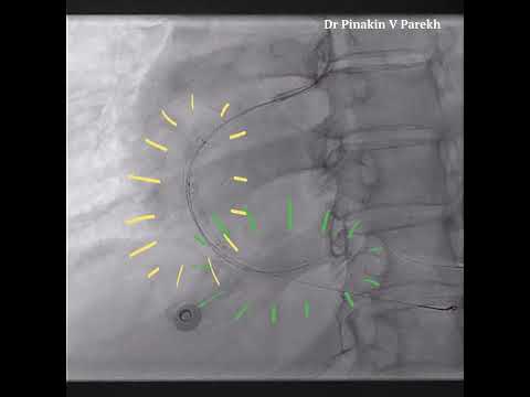 Basics of Angioplasty