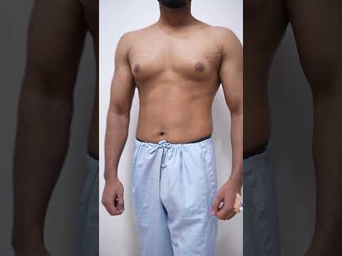 How To Get Rid Of Man Boobs Permanently #shorts